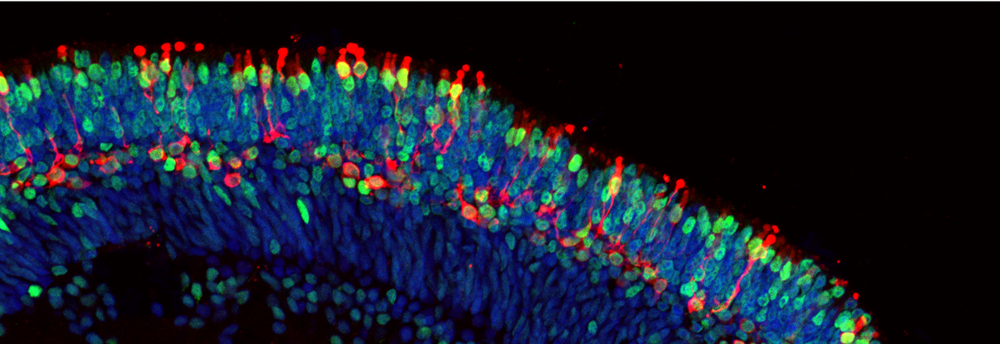 'Mini eyes’ help researchers understand blindness in rare condition ...
